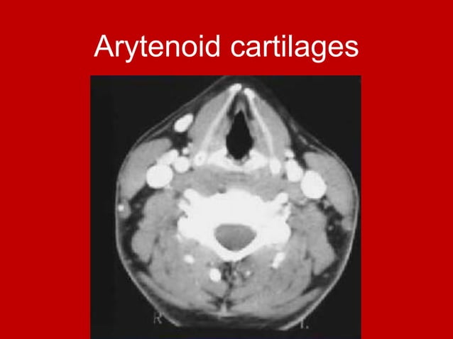 larynx Imaging 1st part laryngeal anatomy CT MRI Dr Ahmed Esawy | PDF