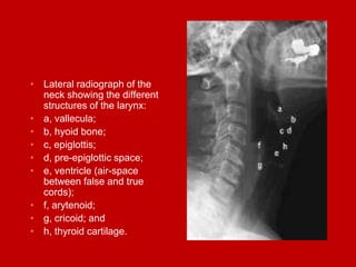Thyroid Cartilage X Ray