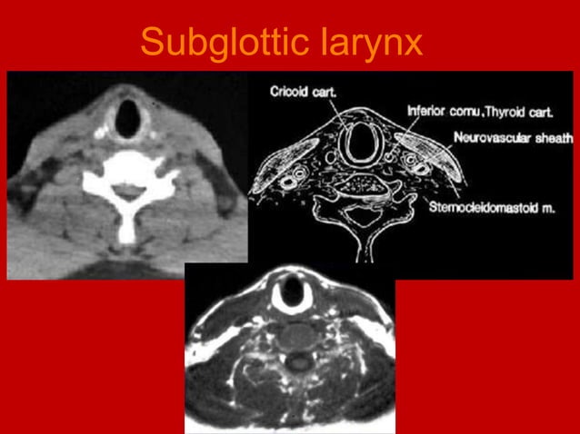 larynx Imaging 1st part laryngeal anatomy CT MRI Dr Ahmed Esawy | PPT