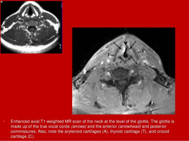 larynx Imaging 1st part laryngeal anatomy CT MRI Dr Ahmed Esawy