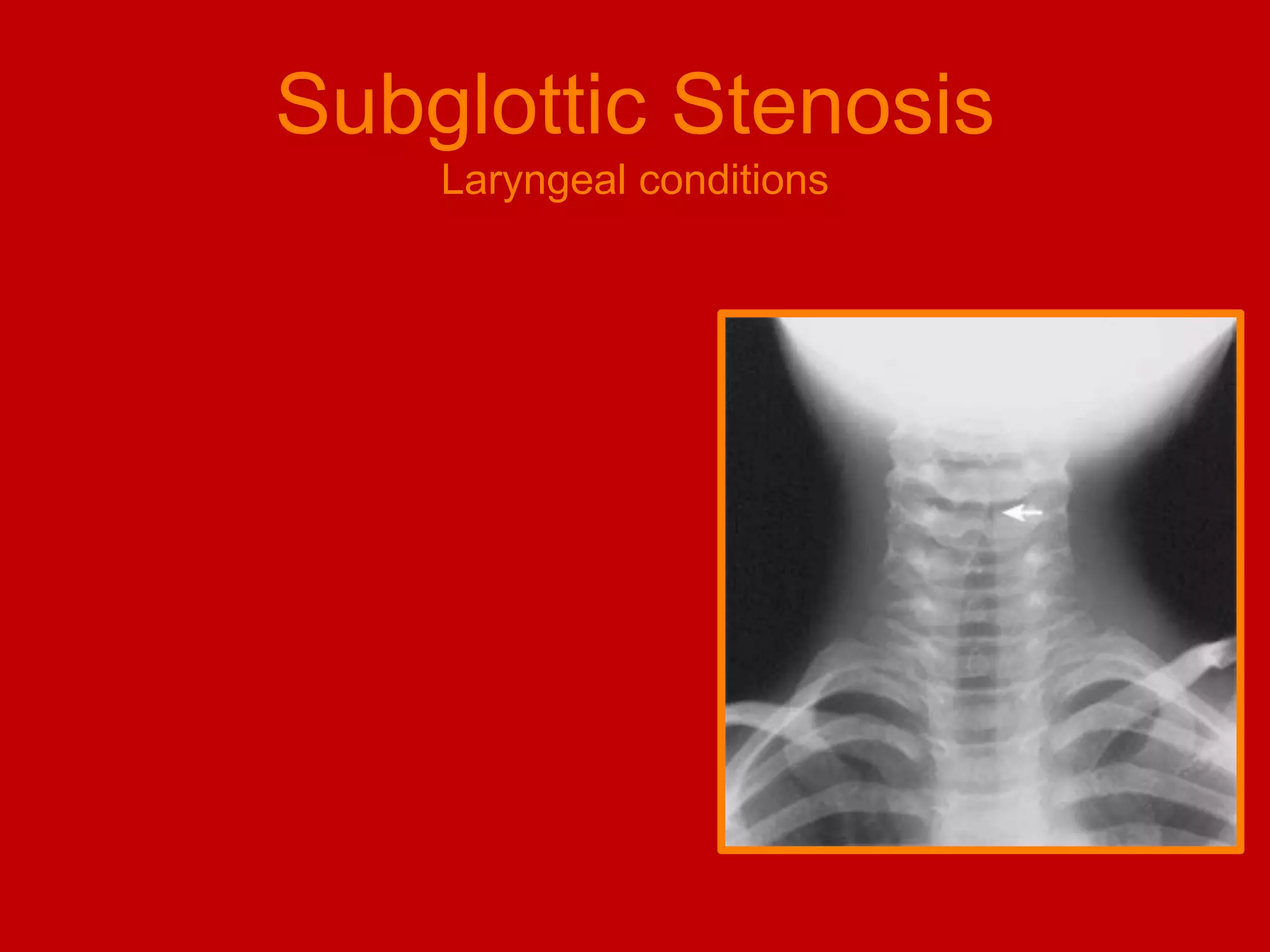 Larynx Imaging 2nd part laryngeal congenital inflammatory traumatic CT ...