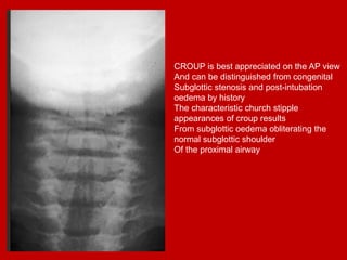 Larynx Imaging 2nd part laryngeal congenital inflammatory traumatic CT ...