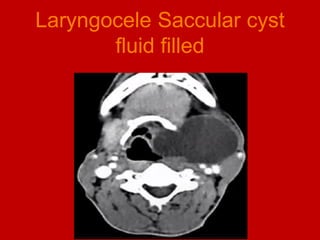 Saccular Cyst
