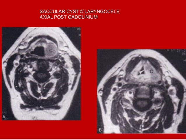 Larynx Imaging 2nd part laryngeal congenital inflammatory traumatic C…