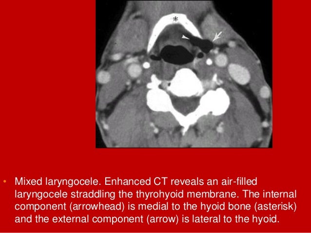 Larynx Imaging 2nd part laryngeal congenital inflammatory traumatic C…