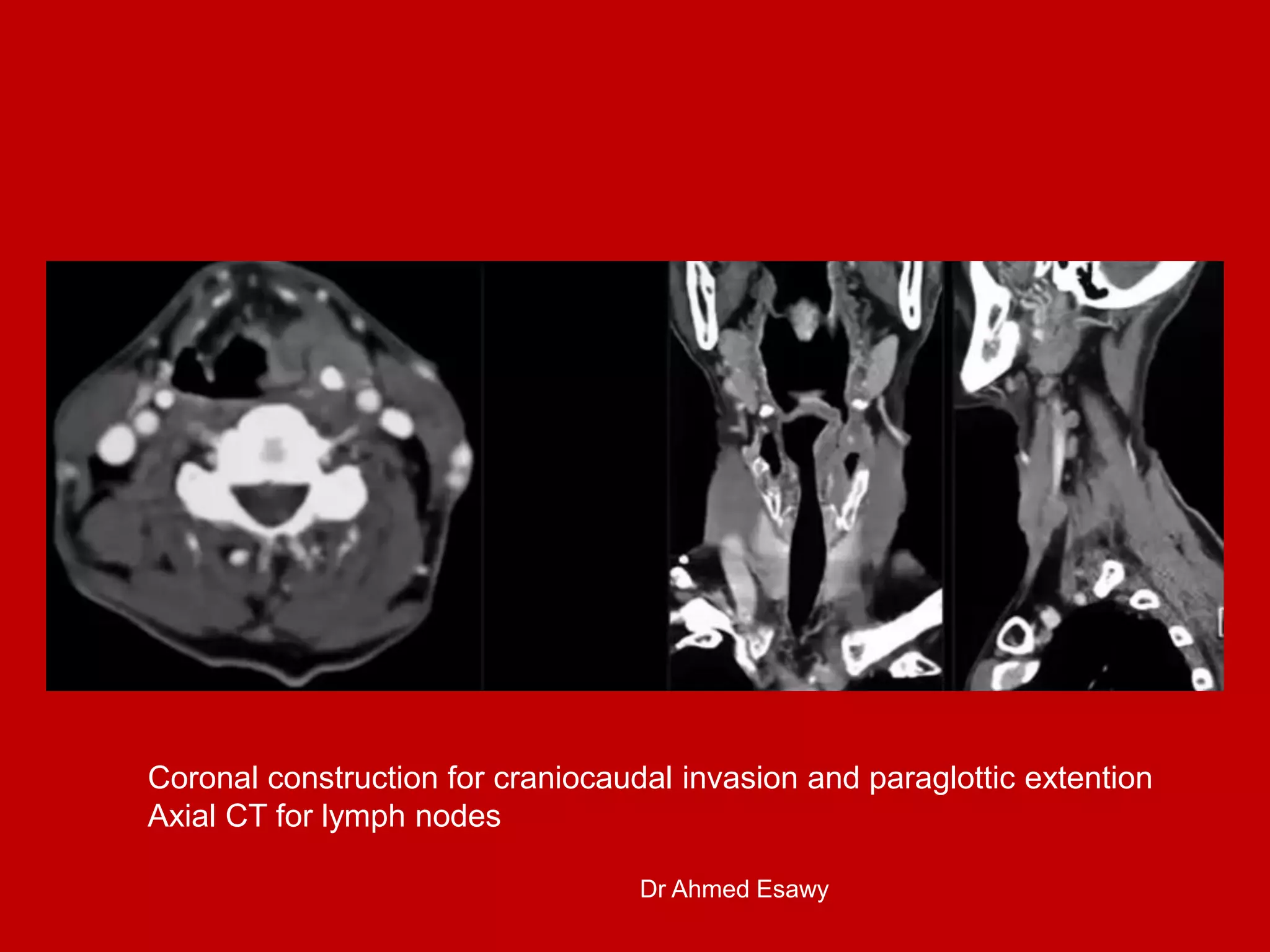 Larynx Imaging 3rd part laryngeal neoplasm CT MRI Dr Ahmed Esawy | PDF
