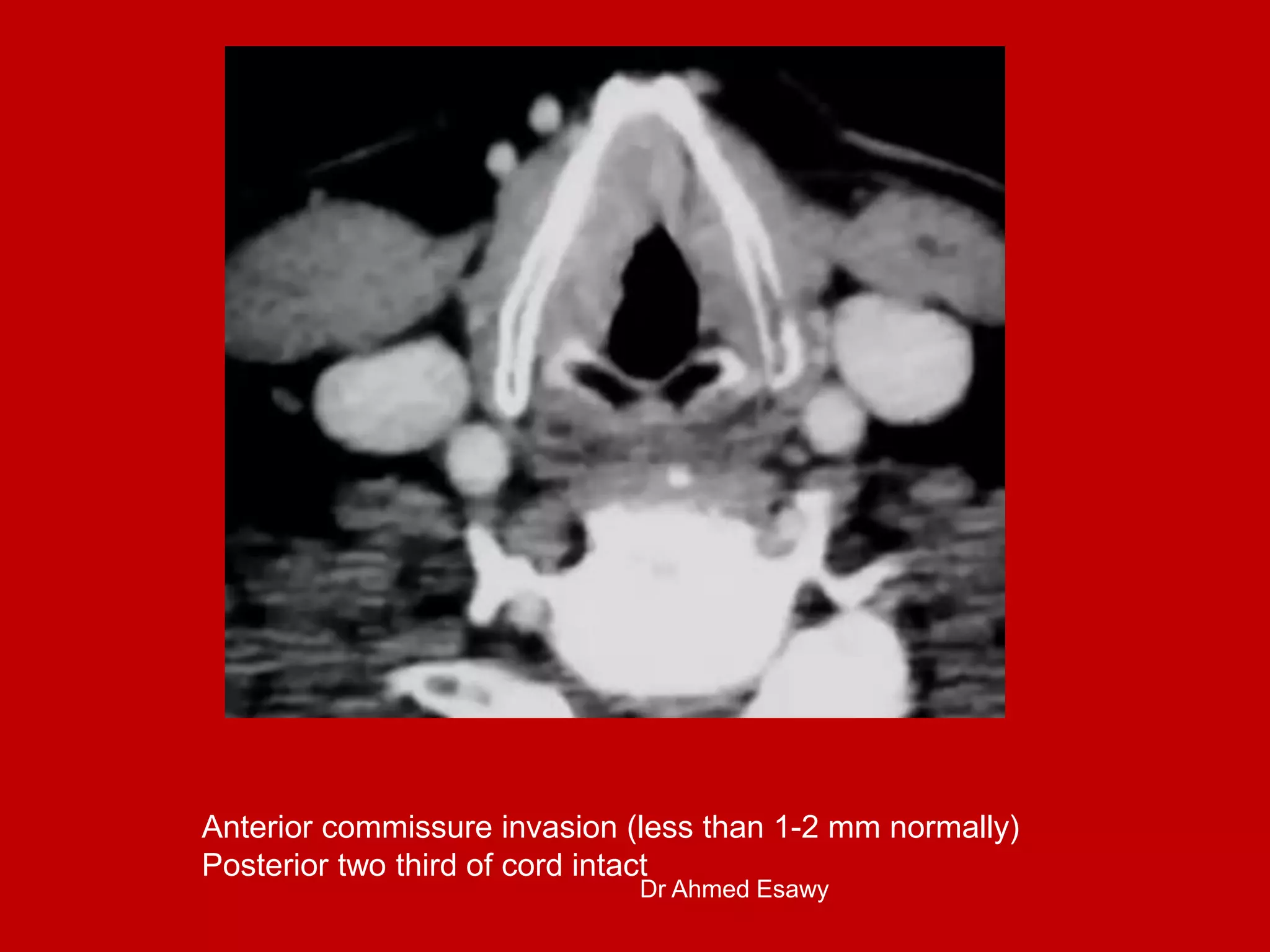 Larynx Imaging 3rd part laryngeal neoplasm CT MRI Dr Ahmed Esawy | PDF
