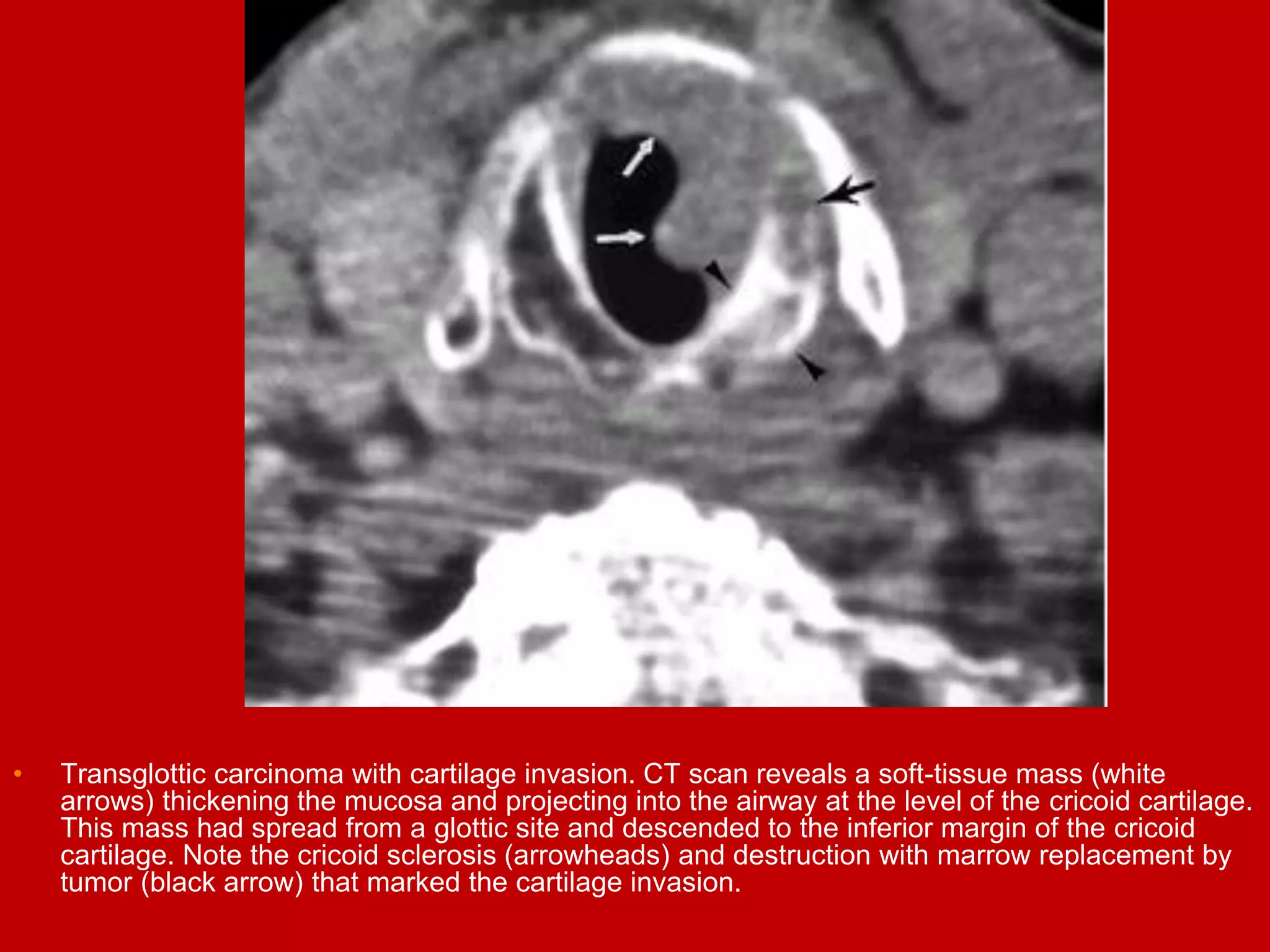 Larynx Imaging 3rd part laryngeal neoplasm CT MRI Dr Ahmed Esawy | PDF