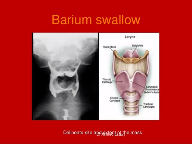 Larynx Imaging 3rd part laryngeal neoplasm CT MRI Dr Ahmed Esawy