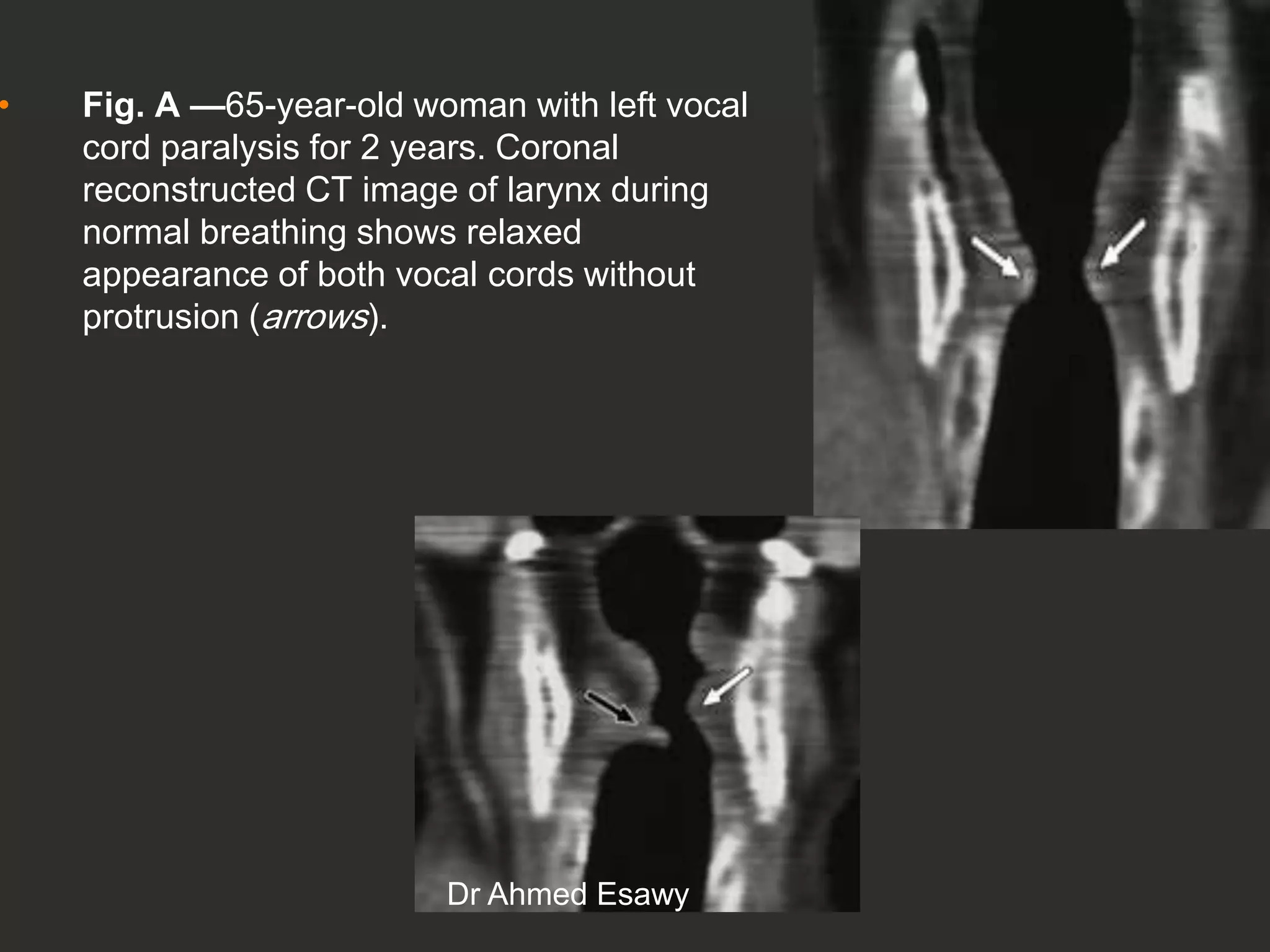 Larynx Imaging 4th part virtual laryngoscopy vocal cord paralysis CT ...