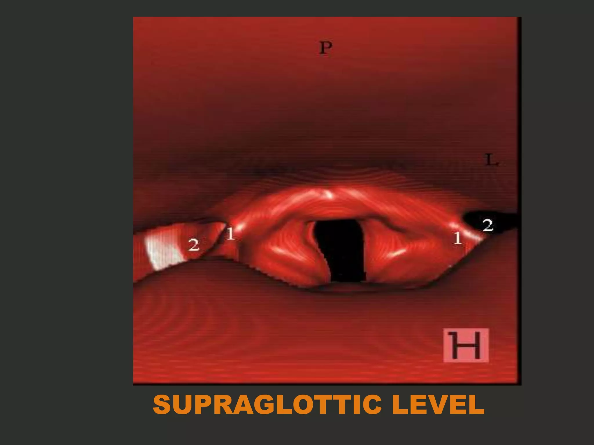 Larynx Imaging 4th part virtual laryngoscopy vocal cord paralysis CT ...