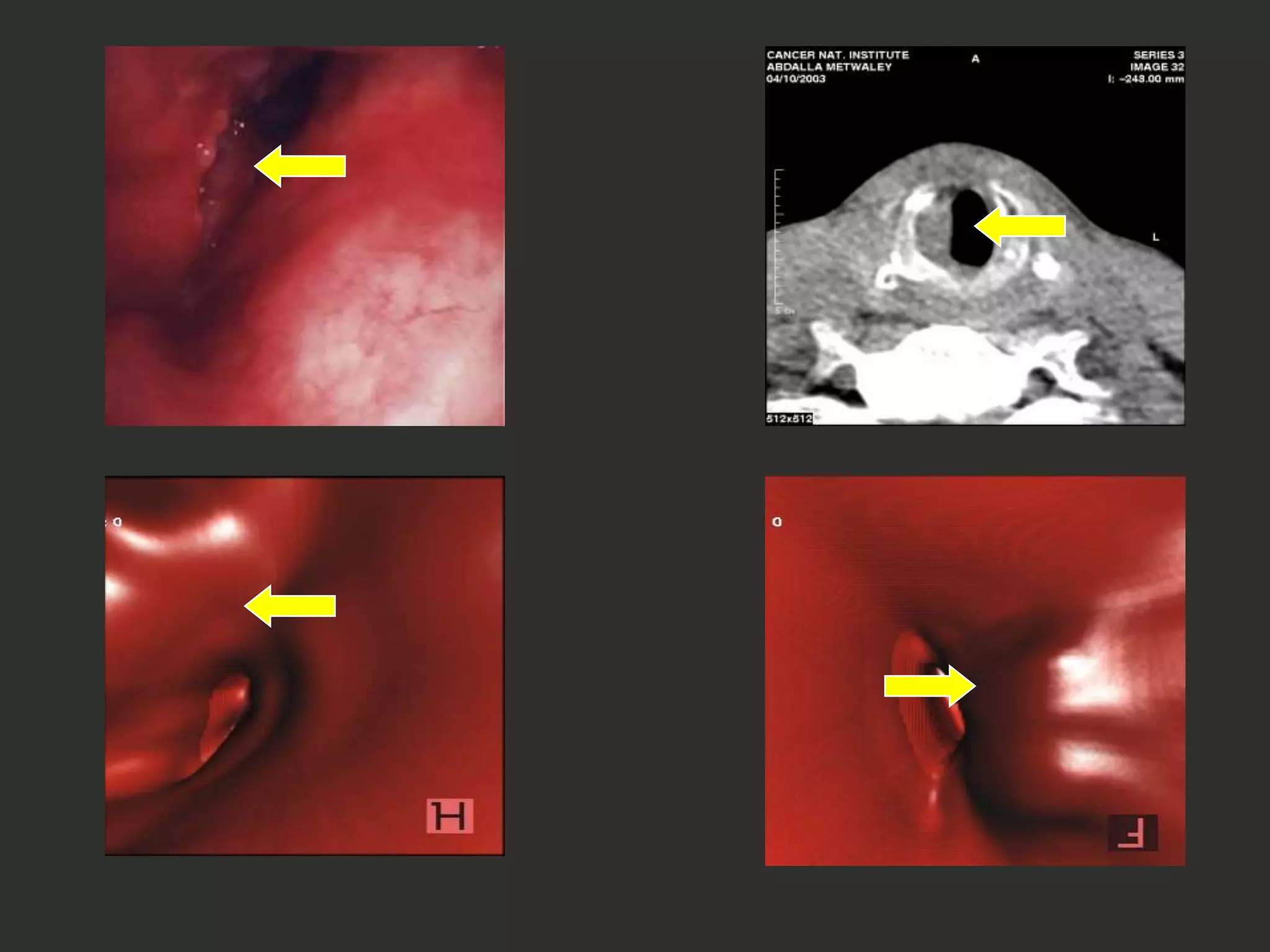 Larynx Imaging 4th part virtual laryngoscopy vocal cord paralysis CT ...