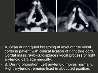 Larynx Imaging 4th part virtual laryngoscopy vocal cord paralysis CT ...