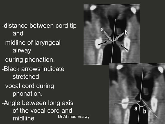 Larynx Imaging 4th part virtual laryngoscopy vocal cord paralysis CT ...