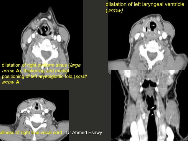 Larynx Imaging 4th part virtual laryngoscopy vocal cord paralysis CT ...