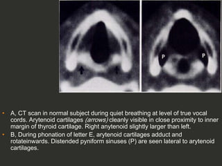 Larynx Imaging 4th part virtual laryngoscopy vocal cord paralysis CT ...