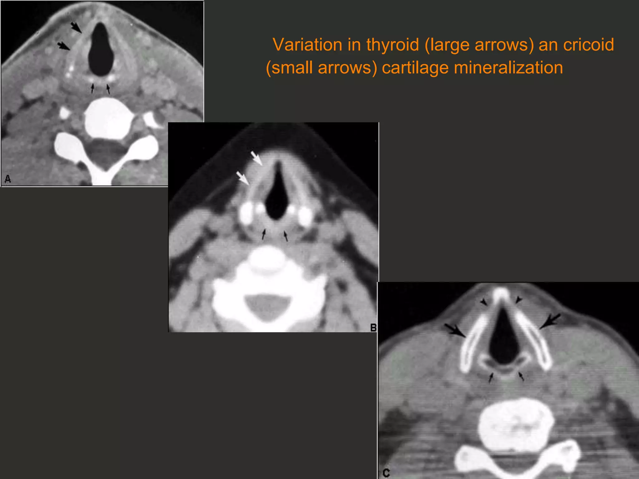 Full Story larynx Imaging CT MRI Dr Ahmed Esawy | PPT