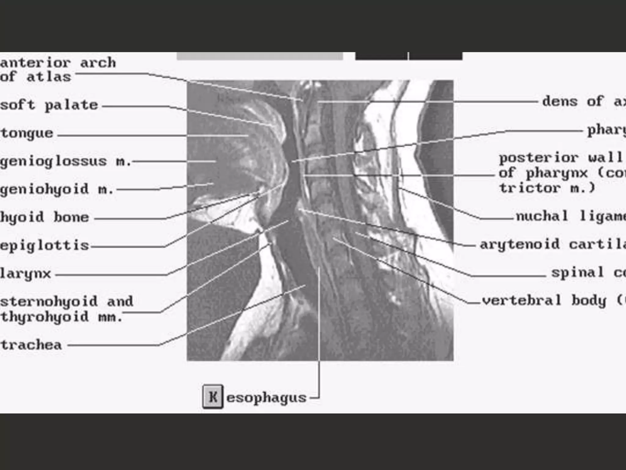 Full Story larynx Imaging CT MRI Dr Ahmed Esawy | PDF | Ear, Nose and ...