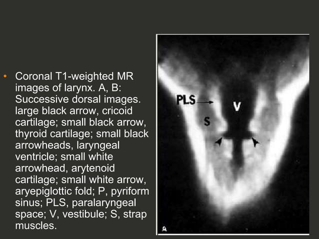 Full Story larynx Imaging CT MRI Dr Ahmed Esawy | PDF | Ear, Nose and ...
