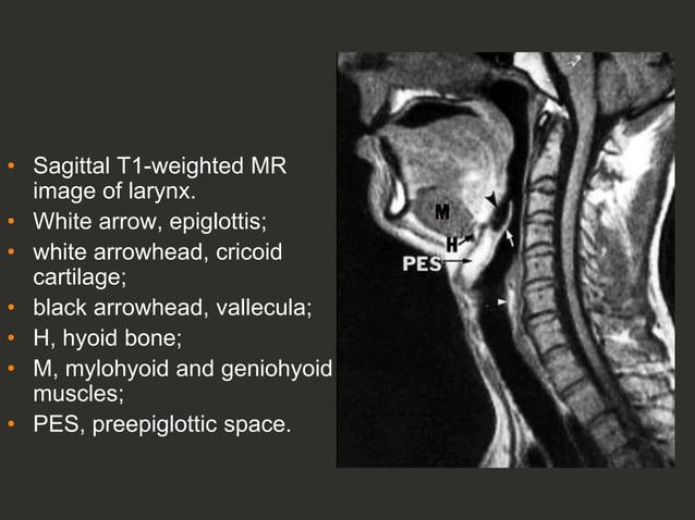 Full Story larynx Imaging CT MRI Dr Ahmed Esawy | PDF | Ear, Nose and ...