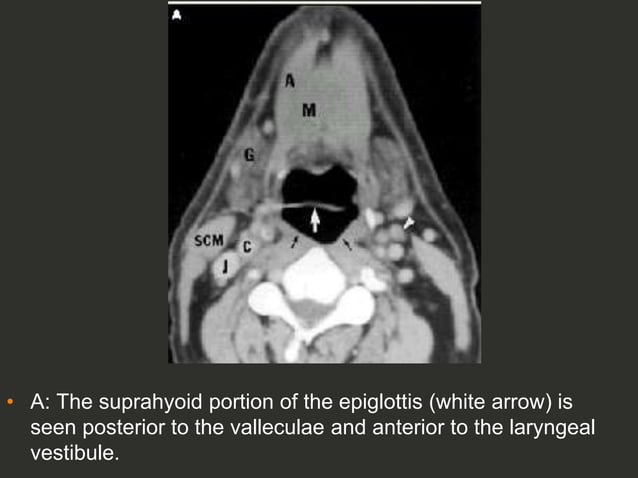 Full Story larynx Imaging CT MRI Dr Ahmed Esawy | PDF | Ear, Nose and ...