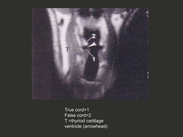 Full Story larynx Imaging CT MRI Dr Ahmed Esawy | PDF | Ear, Nose and ...