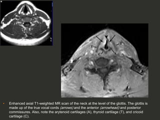 Full Story larynx Imaging CT MRI Dr Ahmed Esawy | PDF