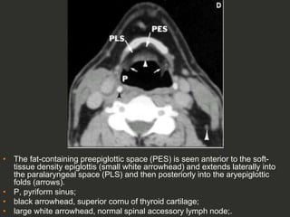 Full Story larynx Imaging CT MRI Dr Ahmed Esawy | PDF