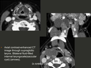 Full Story larynx Imaging CT MRI Dr Ahmed Esawy | PDF