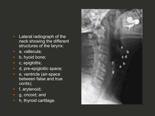 Laryngomalacia Xray