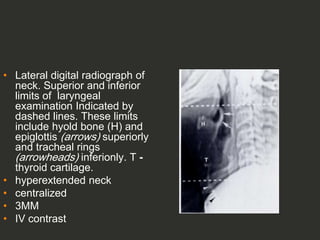 Thyroid Cartilage X Ray