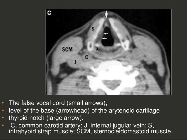 Full Story larynx Imaging CT MRI Dr Ahmed Esawy