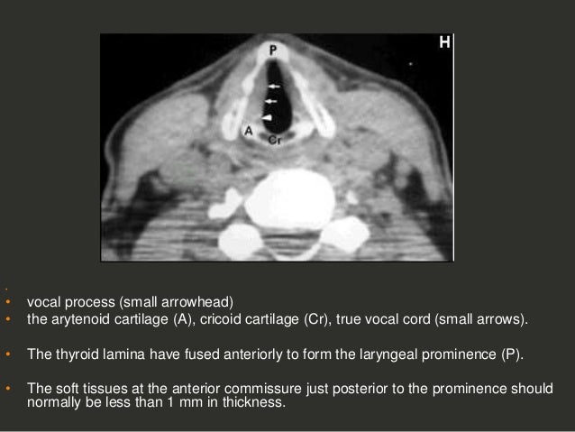 Full Story larynx Imaging CT MRI Dr Ahmed Esawy