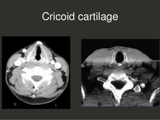 Full Story larynx Imaging CT MRI Dr Ahmed Esawy