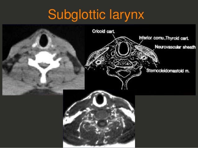Full Story larynx Imaging CT MRI Dr Ahmed Esawy