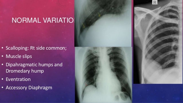 Imaging modalities of diaphragm