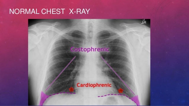 Imaging modalities of diaphragm