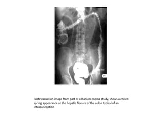 Imaging modalities of intestinal obstruction Mithilesh Kumar Medical ...