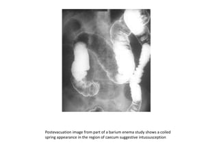 Imaging modalities of intestinal obstruction Mithilesh Kumar Medical ...