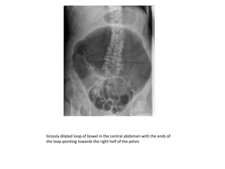 Imaging modalities of intestinal obstruction Mithilesh Kumar Medical ...