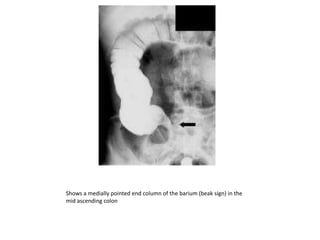 Imaging modalities of intestinal obstruction Mithilesh Kumar Medical ...