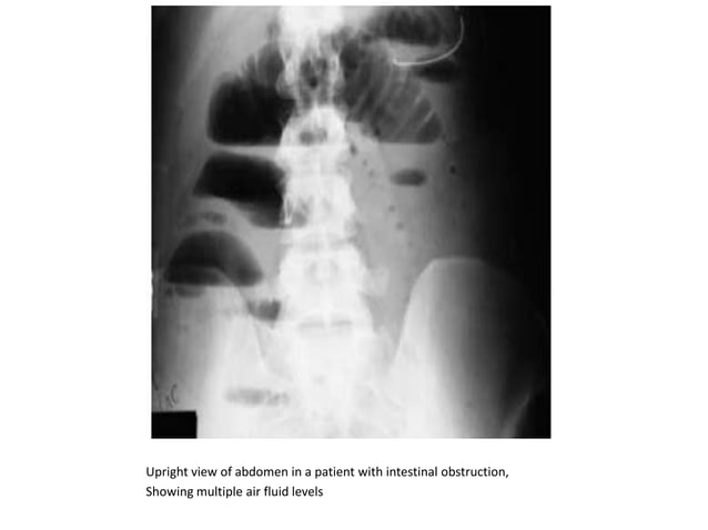 Imaging modalities of intestinal obstruction Mithilesh Kumar Medical ...