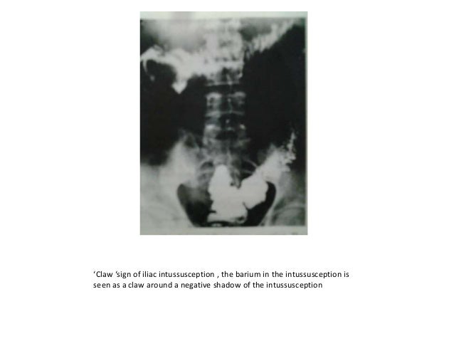 Intussusception Claw Sign Gastrointestinal Imaging | Radiology Key