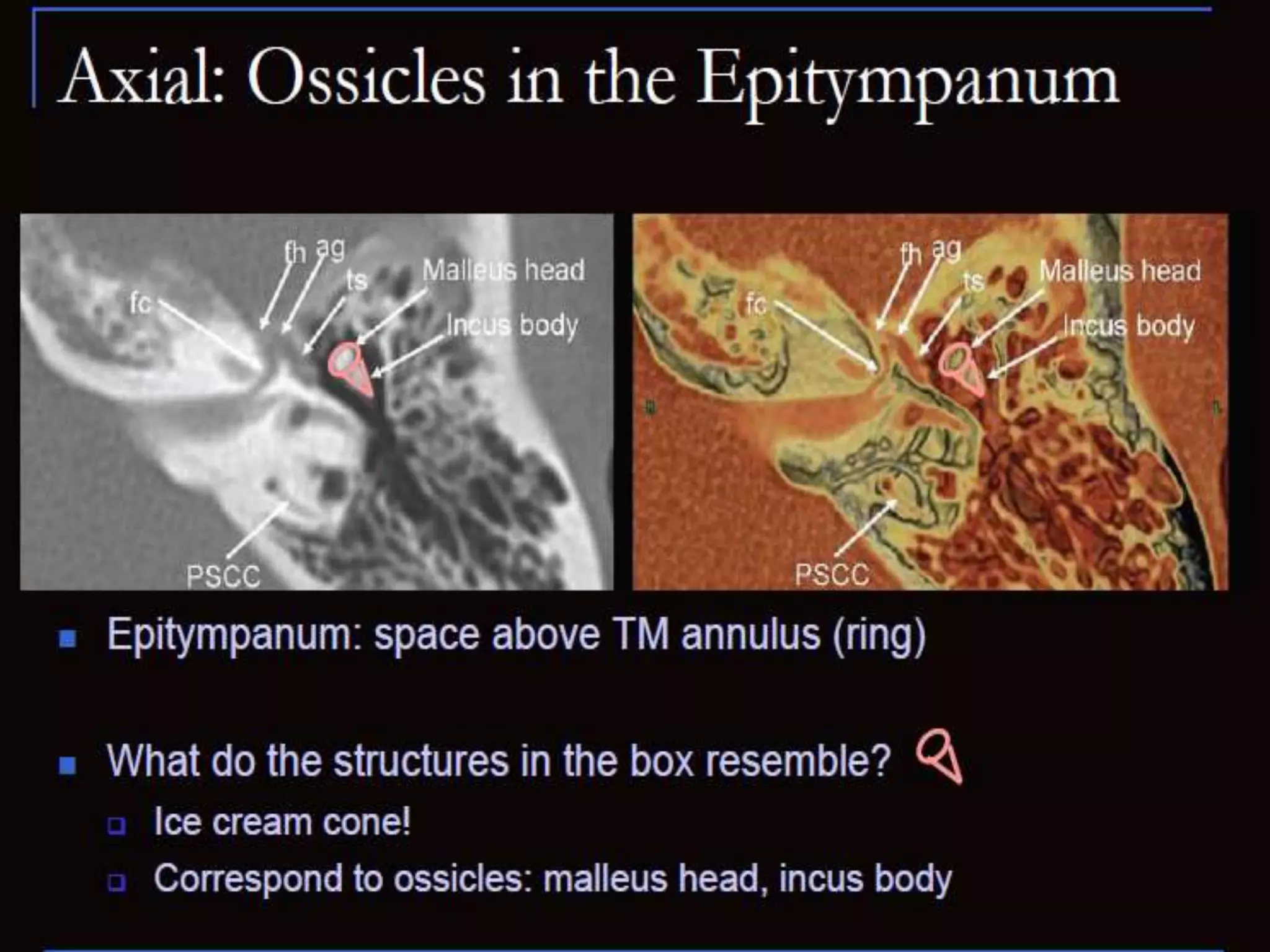 Imaging modalities of the petrous bone | PPTX