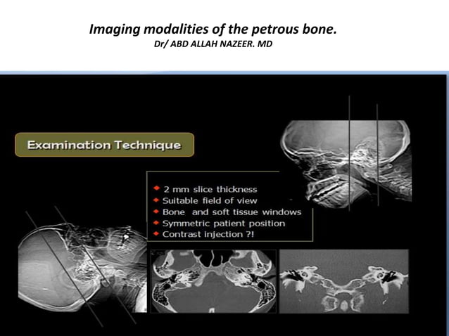Imaging modalities of the petrous bone | PPTX