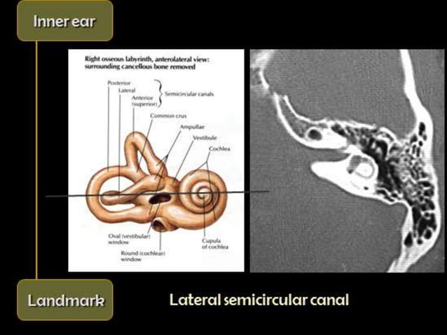 Imaging modalities of the petrous bone | PPTX
