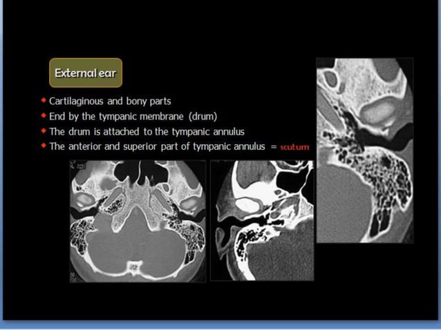 Imaging modalities of the petrous bone | PPTX