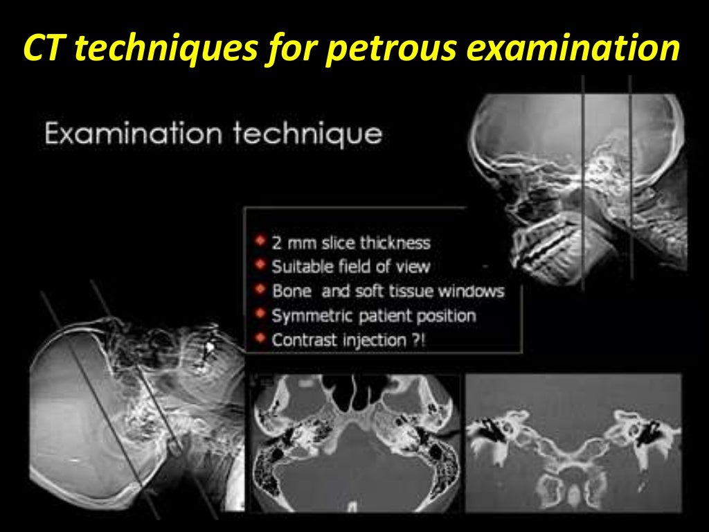 Imaging modalities of the petrous bone