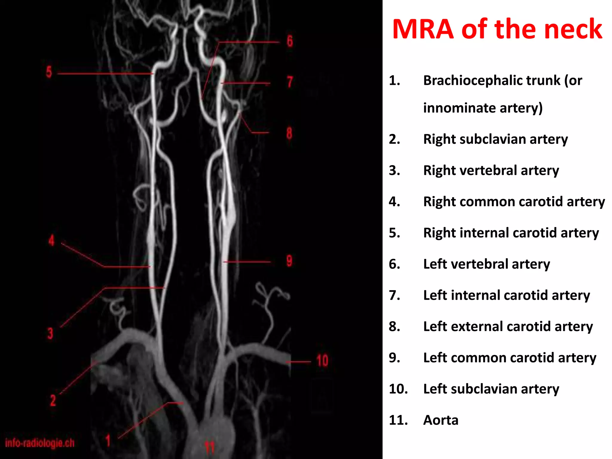 Imaging in neurology - normal MR Angio and Venography | PPTX