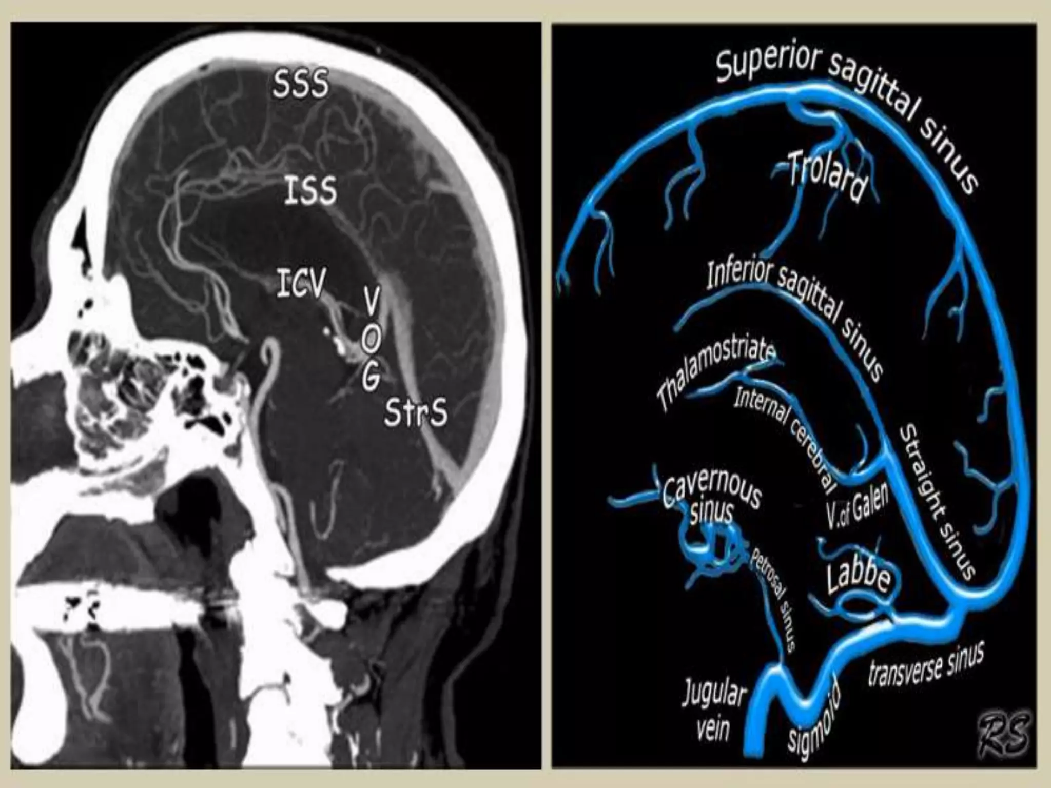 Imaging in neurology - normal MR Angio and Venography | PPTX